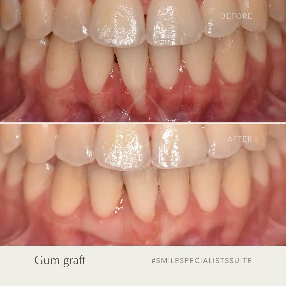 Periodontal Before And After Results Kiama Gallery