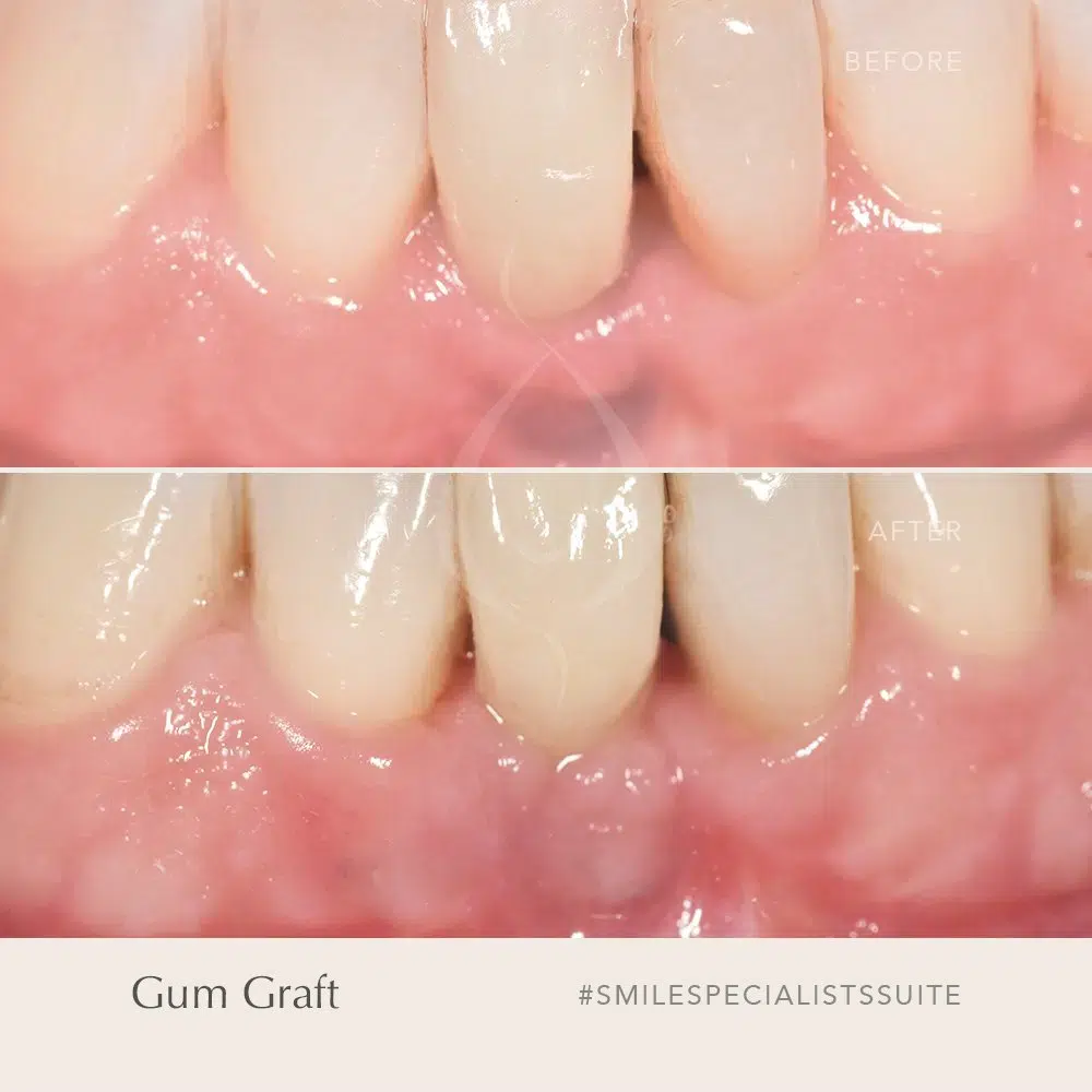 Periodontal Before And After Results Kiama Gallery