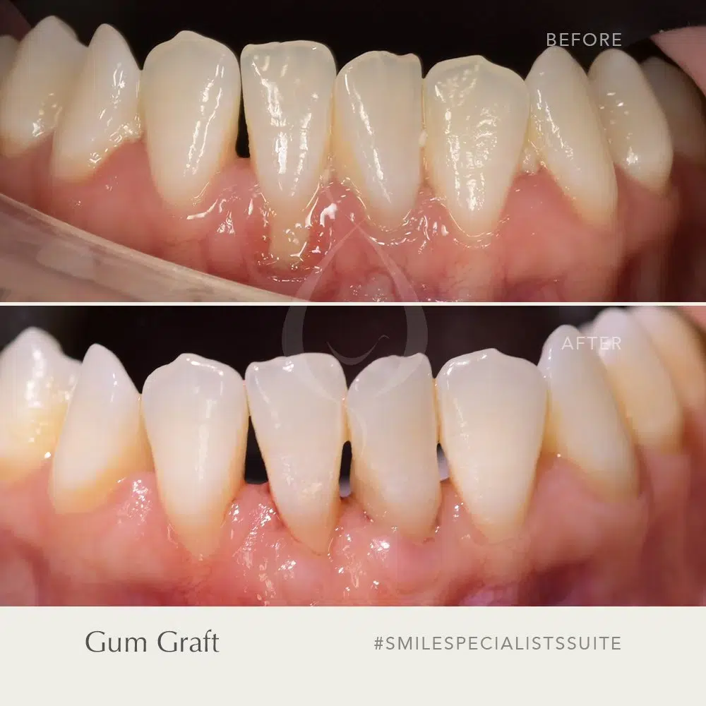 Periodontal Before And After Results Kiama Gallery
