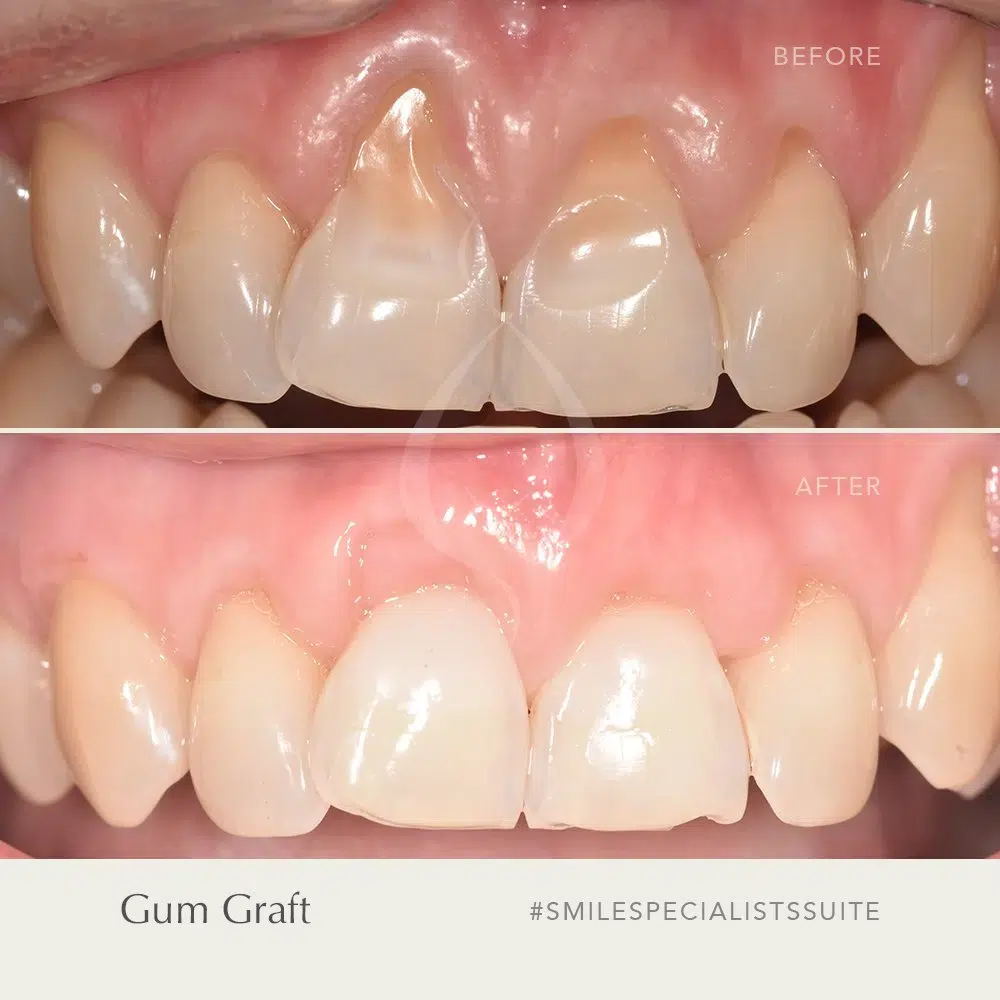 Periodontal Before And After Results Kiama Gallery Periodontal Before And After Results Kiama Gallery