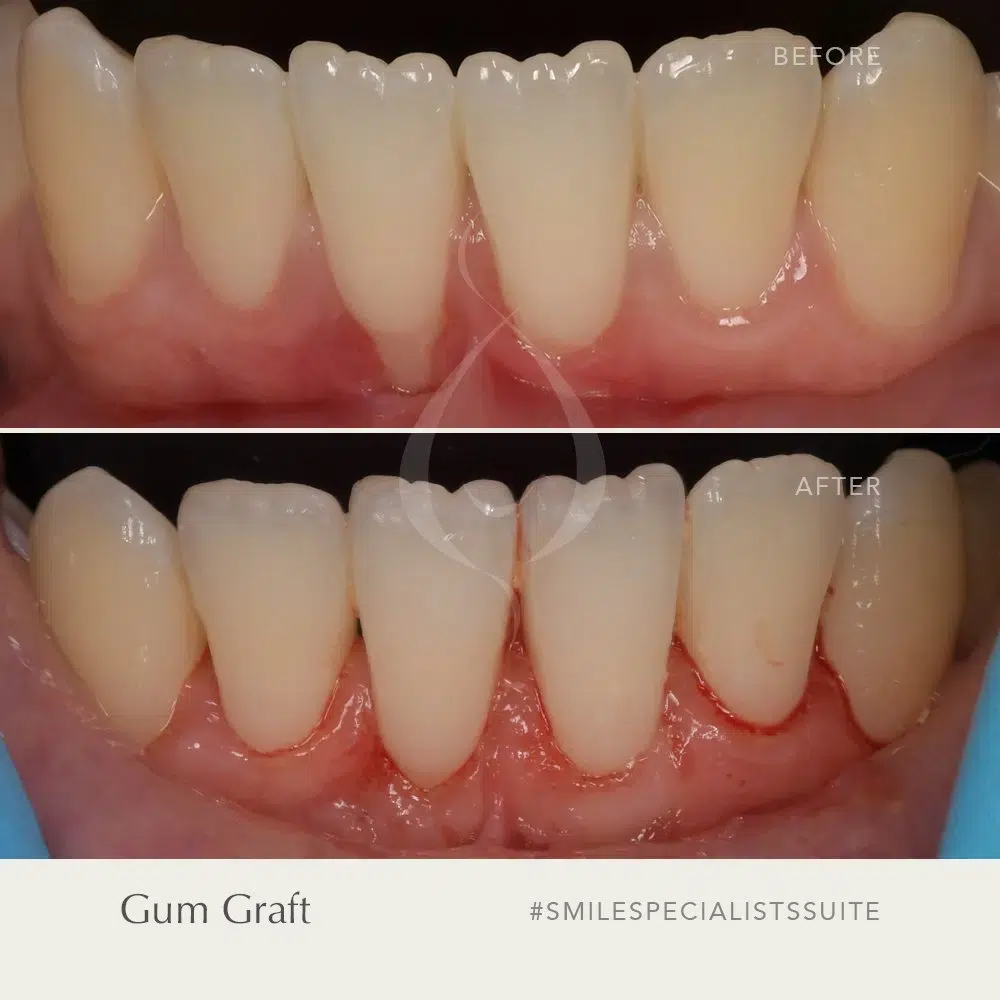 Periodontal Before And After Results Kiama Gallery